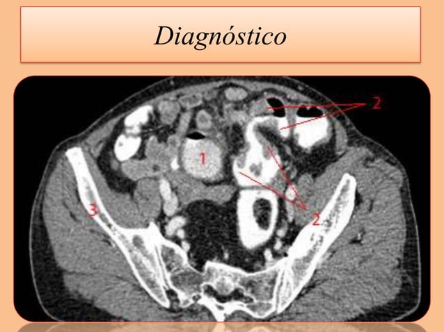 Fístulas intestinales | PPTX