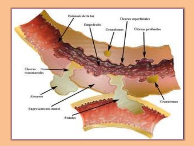 Fístulas intestinales