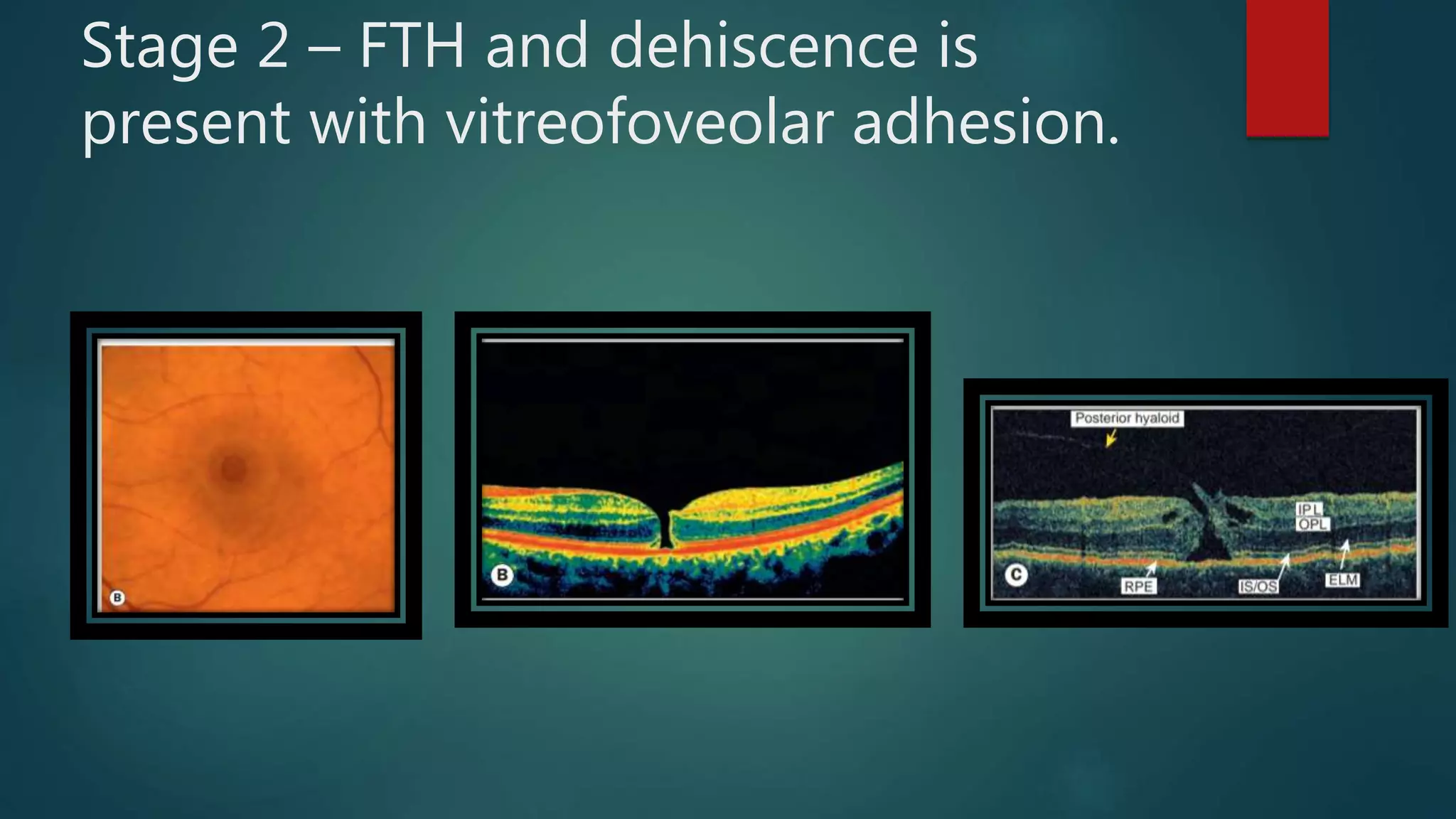Full Thickness Macular Hole (FTMH) | PPT