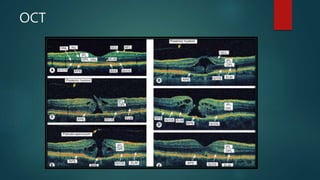 Full Thickness Macular Hole (FTMH) | PPT