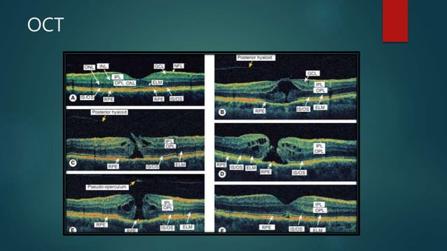 Full Thickness Macular Hole (FTMH) | PPT