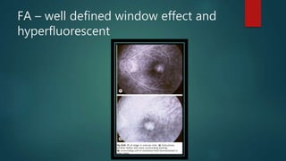 Full Thickness Macular Hole (FTMH) | PPT