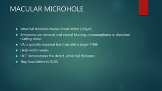 Full Thickness Macular Hole (FTMH) | PPT