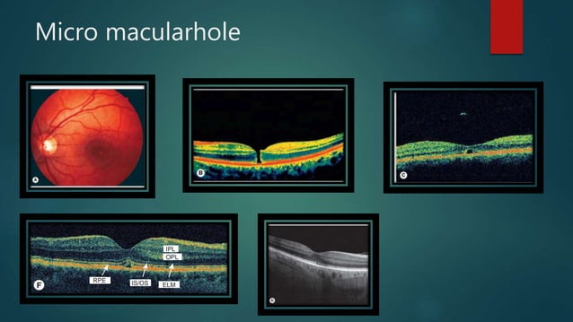 Full Thickness Macular Hole (FTMH) | PPT