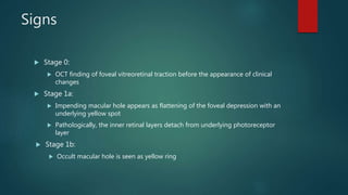 Full Thickness Macular Hole (FTMH) | PPT