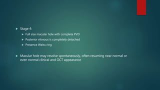 Full Thickness Macular Hole (FTMH) | PPT