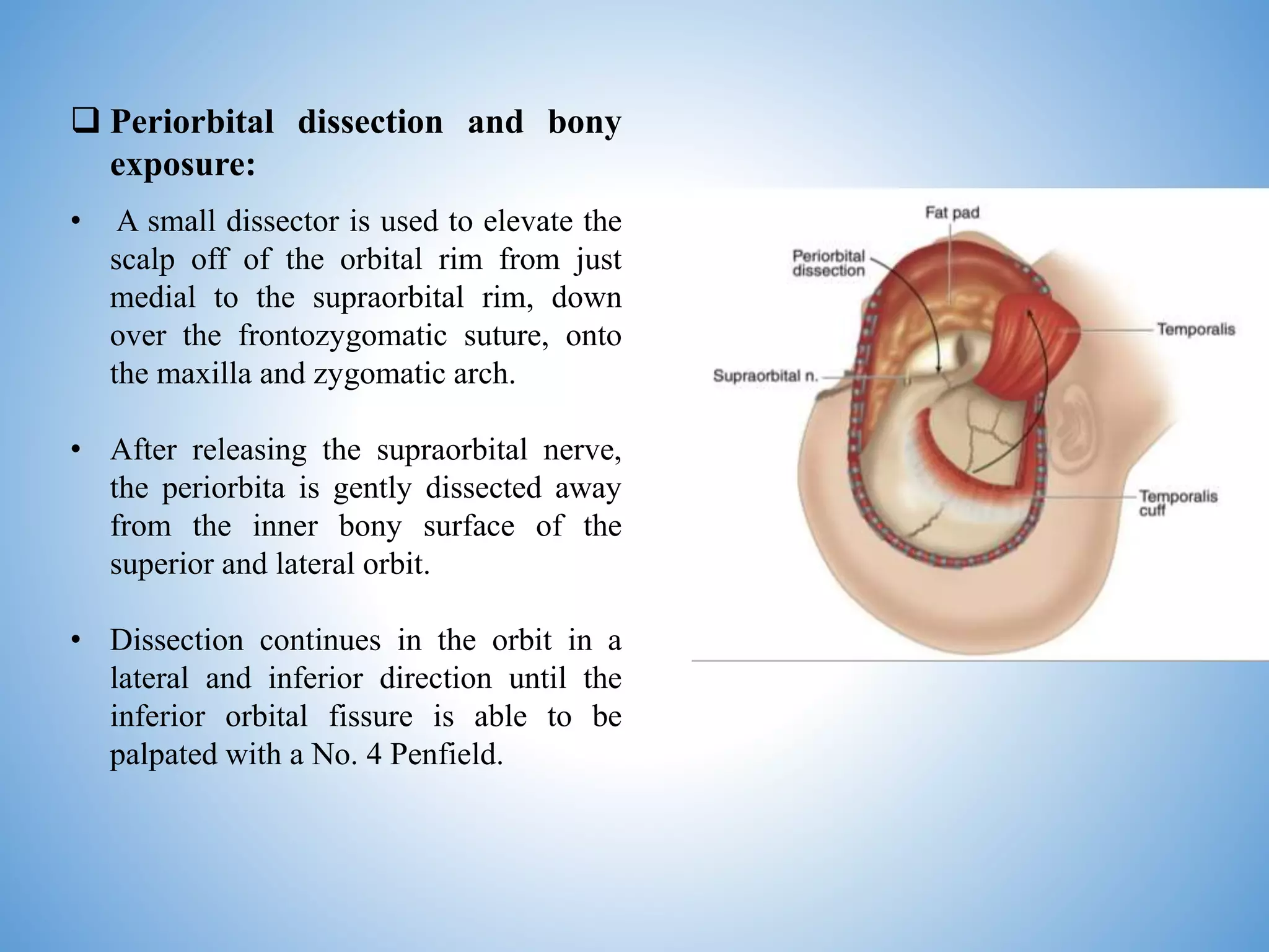 Frontotemporal FTOZ craniotomy | PPTX