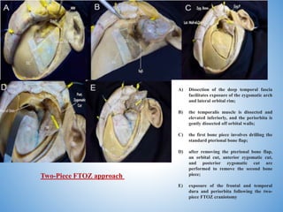 Frontotemporal FTOZ craniotomy | PPTX