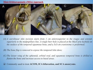 Frontotemporal FTOZ craniotomy | PPTX