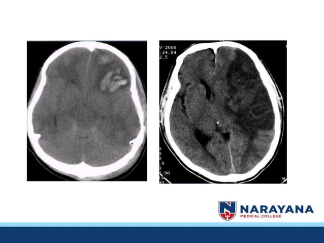 FTP Decompressive Craniotomy: How I do it? | PPTX