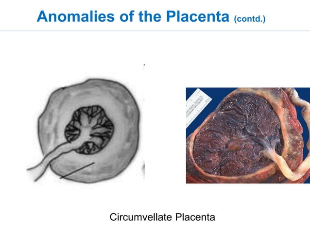Structure-function relationship of the placenta and its anomalies | PPT