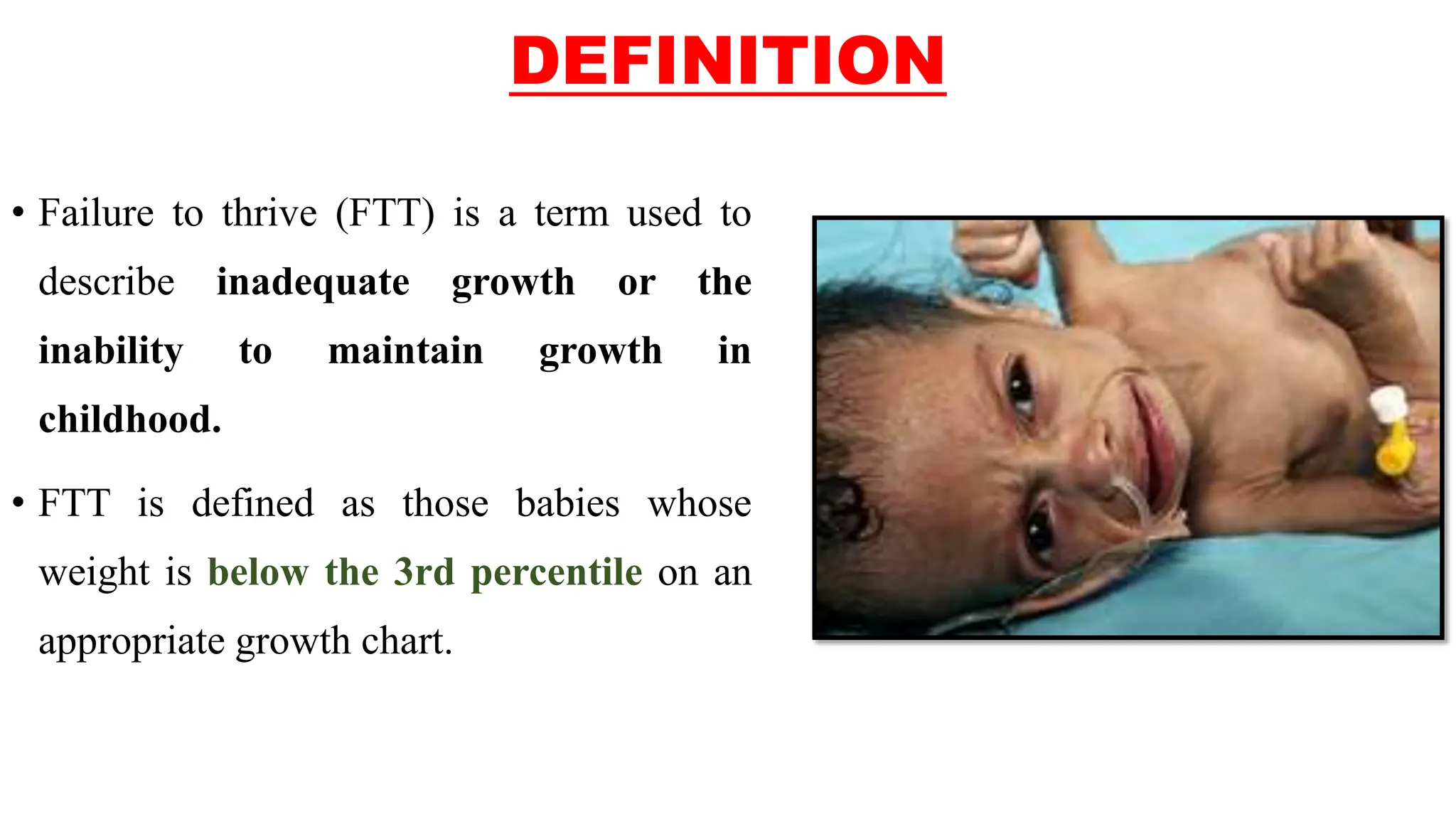 Failure to thrive | PPTX