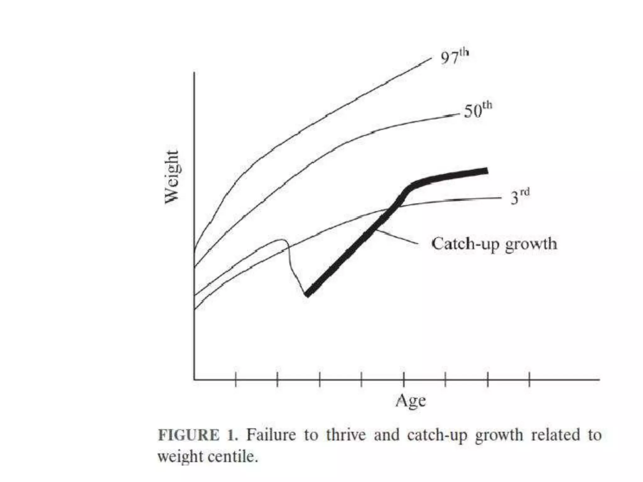 Approach to a child with failure to thrive | PPTX