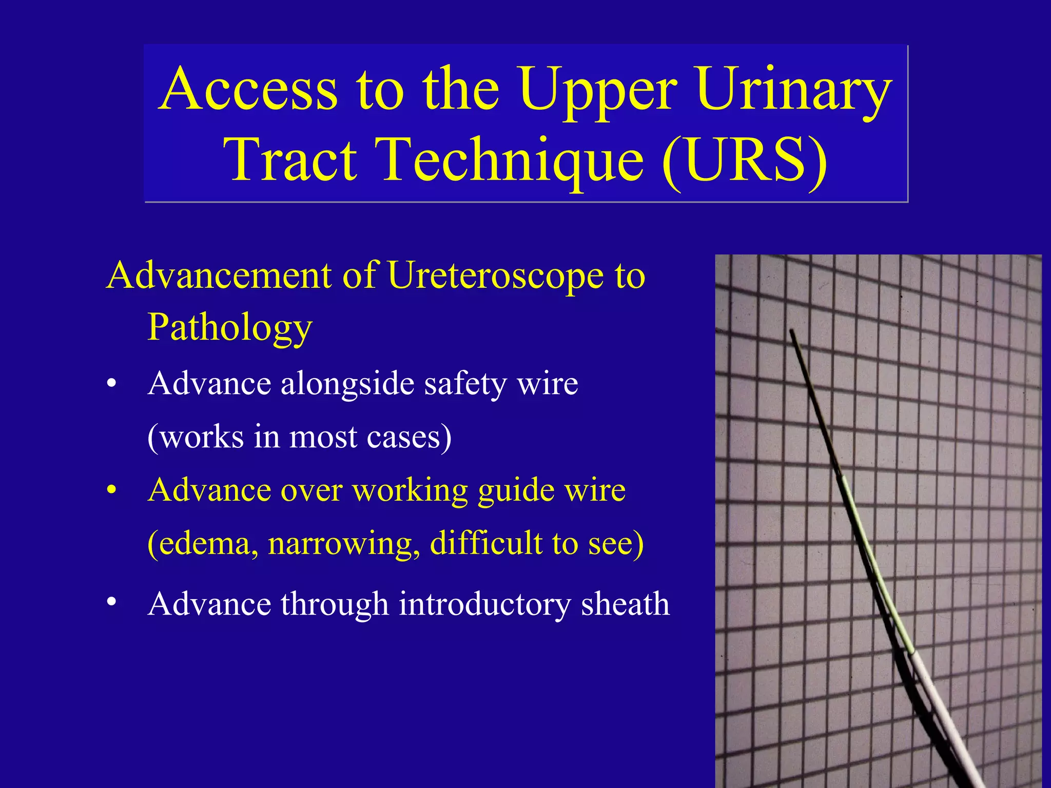 Retrograde Intrarenal Ureteroscopic Surgery (RIRS) | PPT
