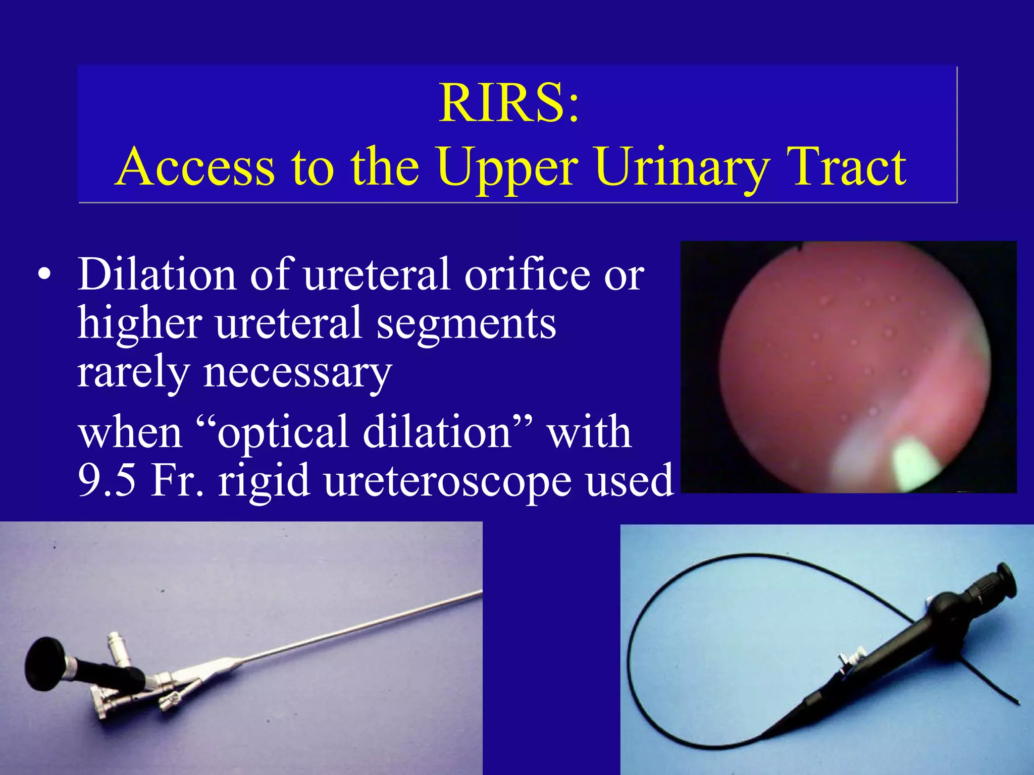 Retrograde Intrarenal Ureteroscopic Surgery (RIRS) | PPT