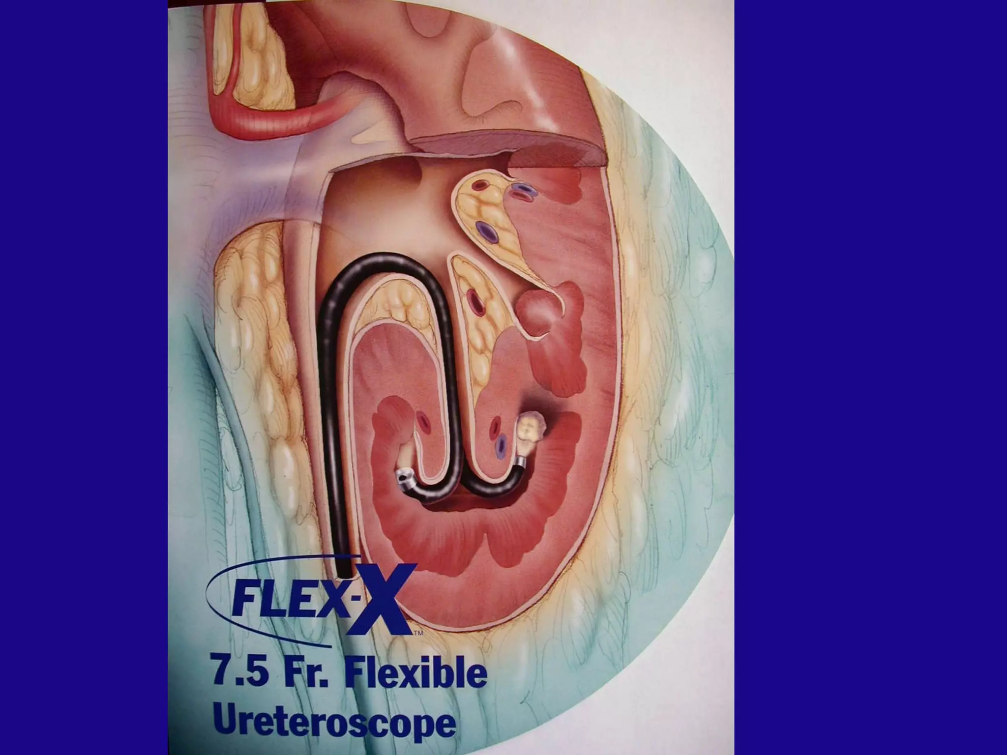 Retrograde Intrarenal Ureteroscopic Surgery (RIRS) | PPT