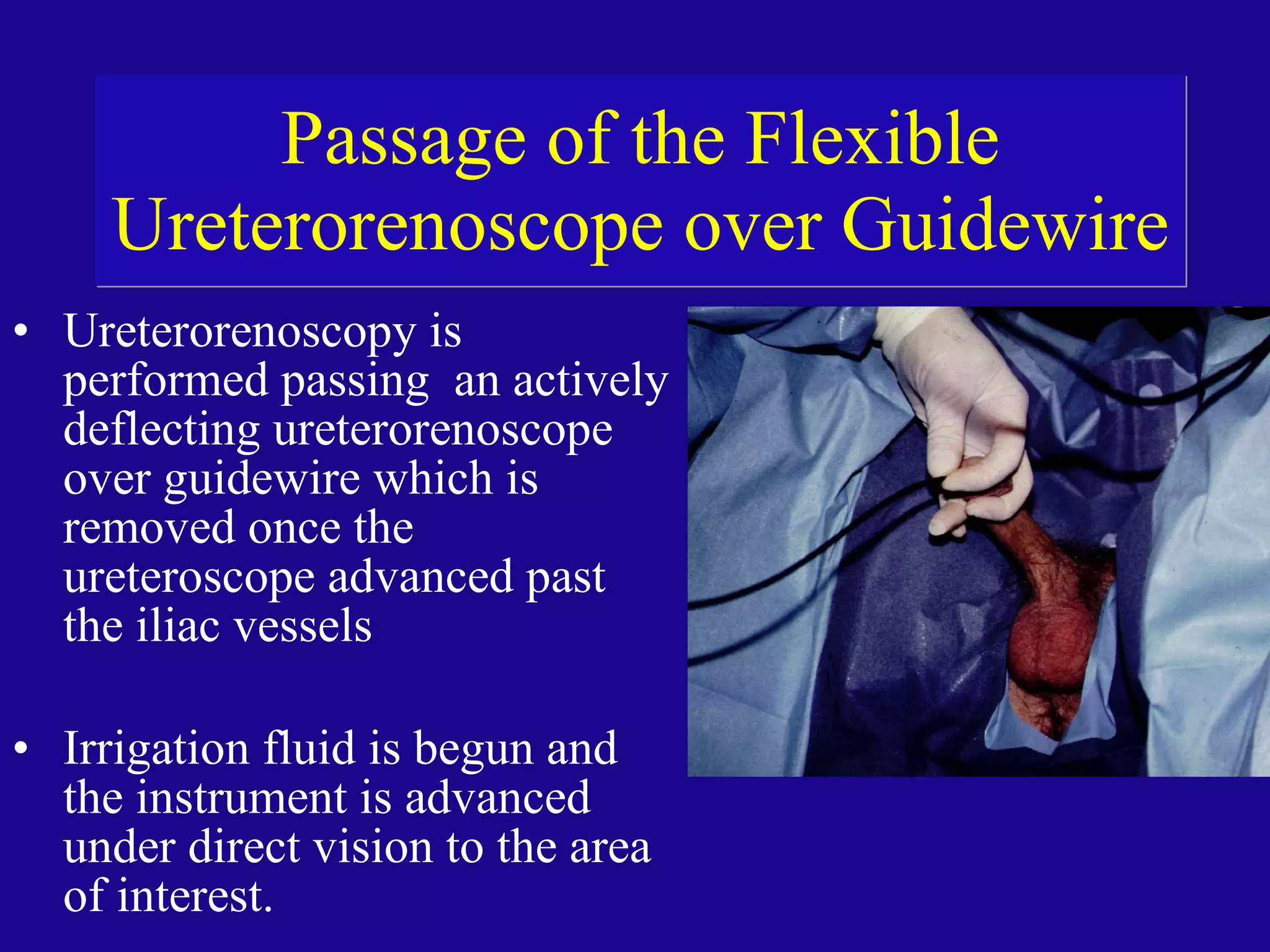 Retrograde Intrarenal Ureteroscopic Surgery (RIRS) | PPT