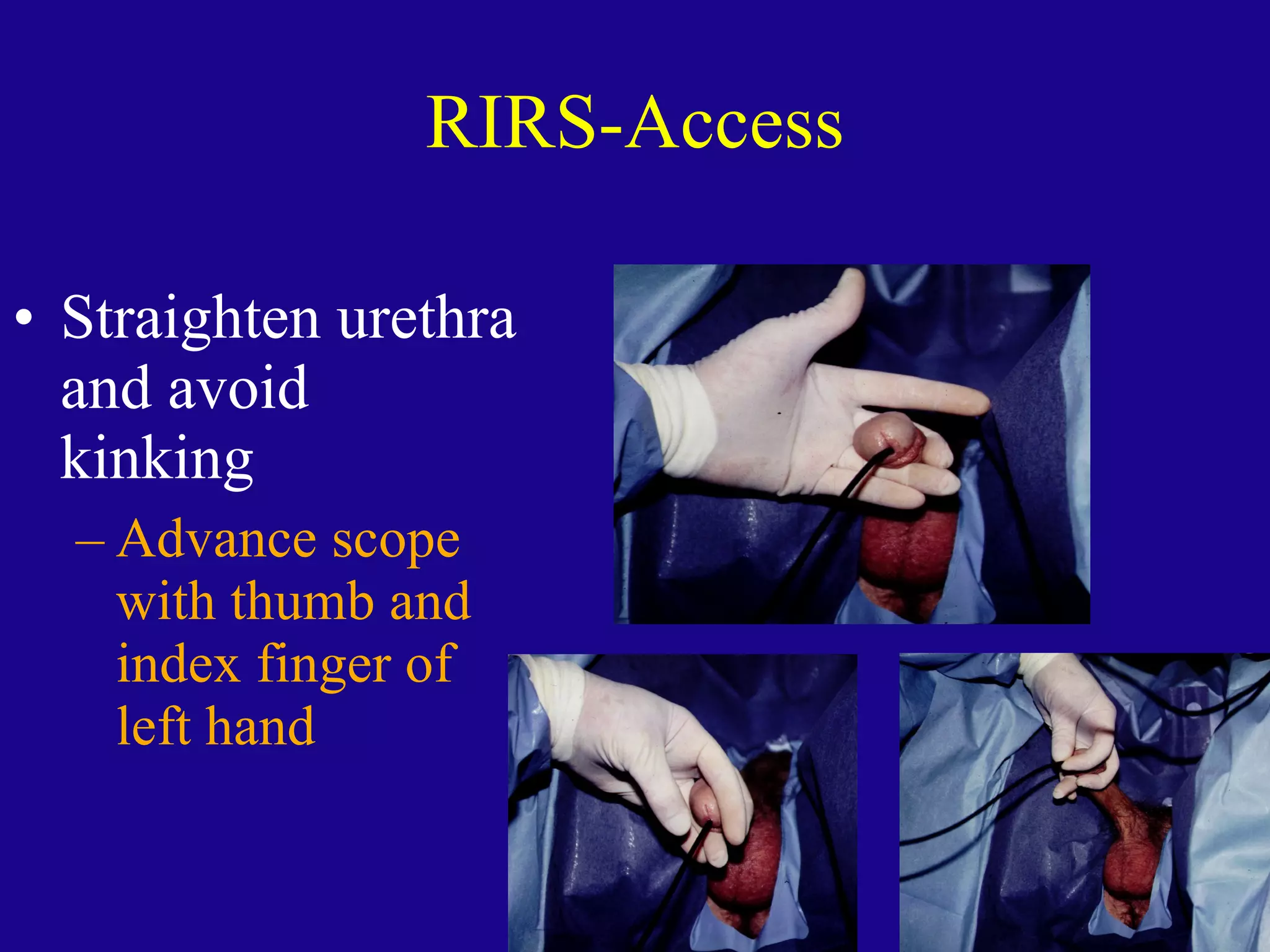Retrograde Intrarenal Ureteroscopic Surgery (RIRS) | PPT