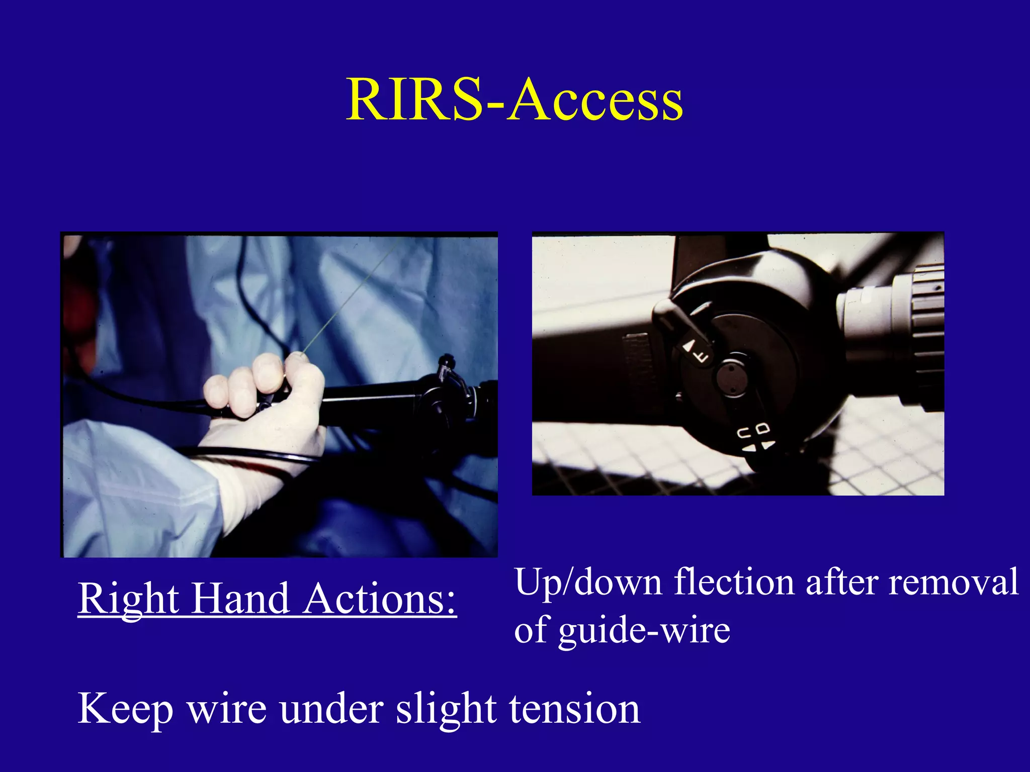 Retrograde Intrarenal Ureteroscopic Surgery (RIRS) | PPT