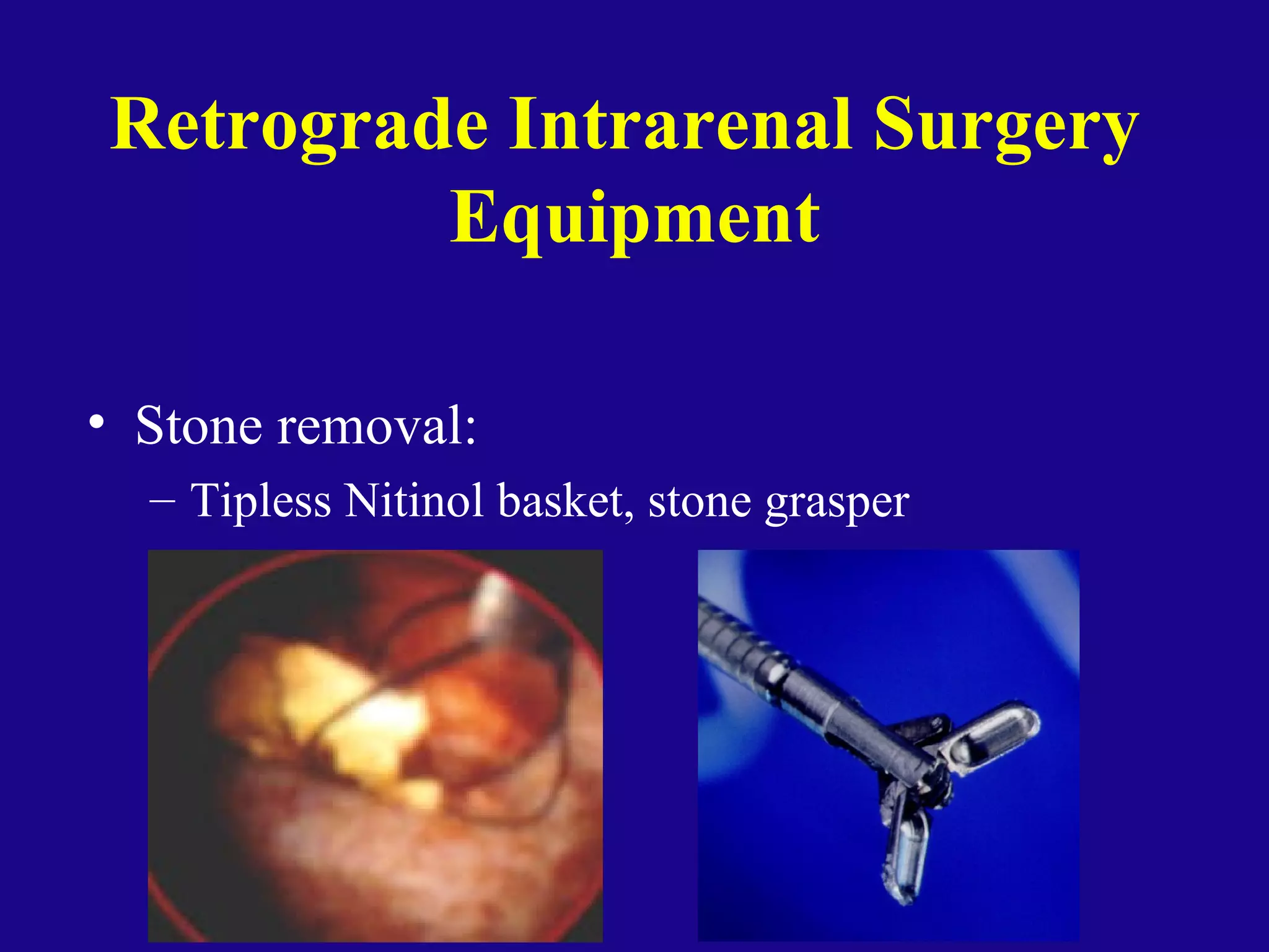 Retrograde Intrarenal Ureteroscopic Surgery (RIRS) | PPT