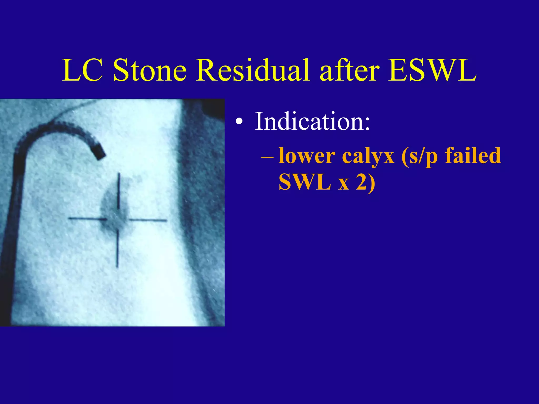 Retrograde Intrarenal Ureteroscopic Surgery (RIRS) | PPT