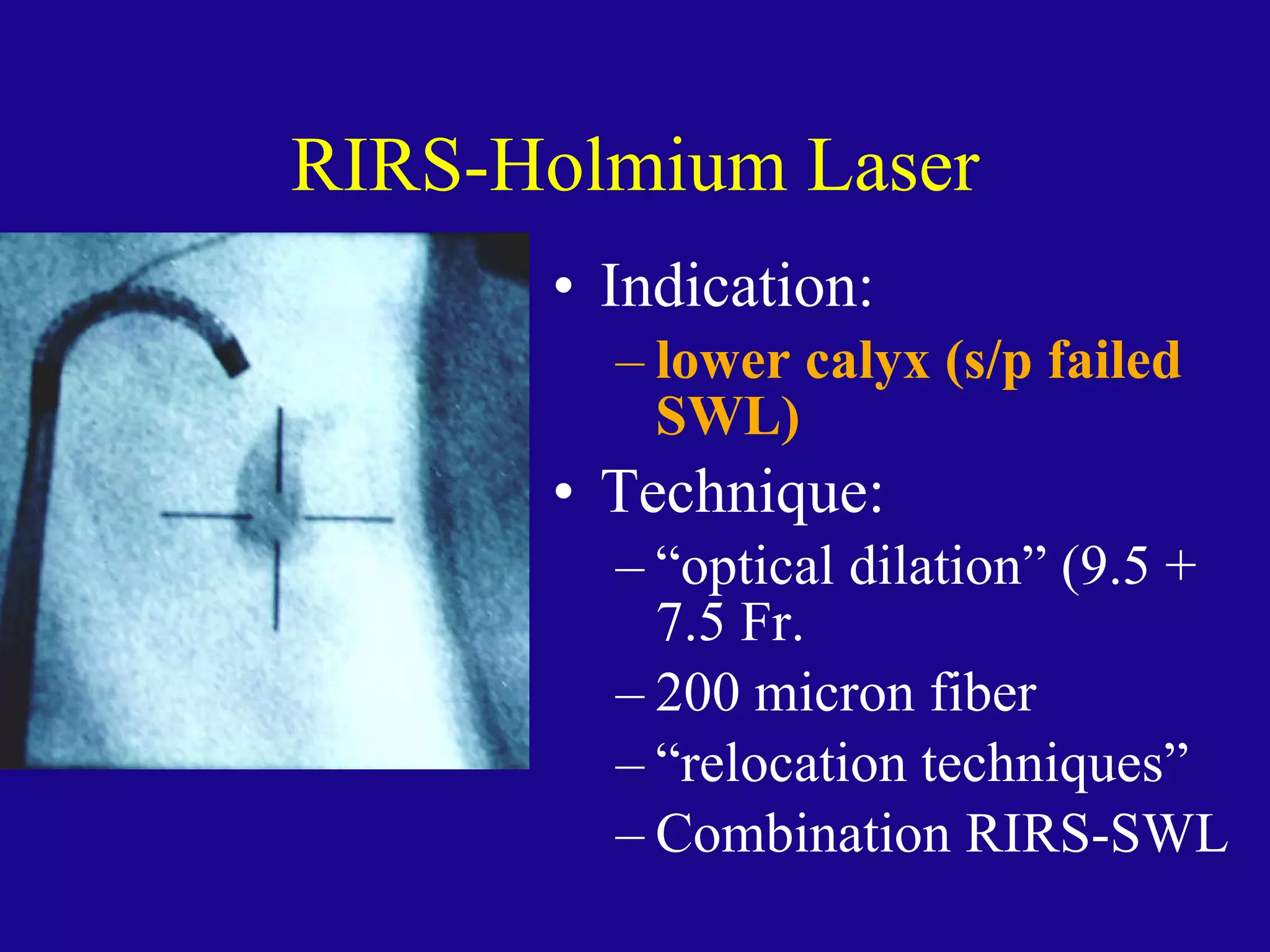 Retrograde Intrarenal Ureteroscopic Surgery (RIRS) | PPT