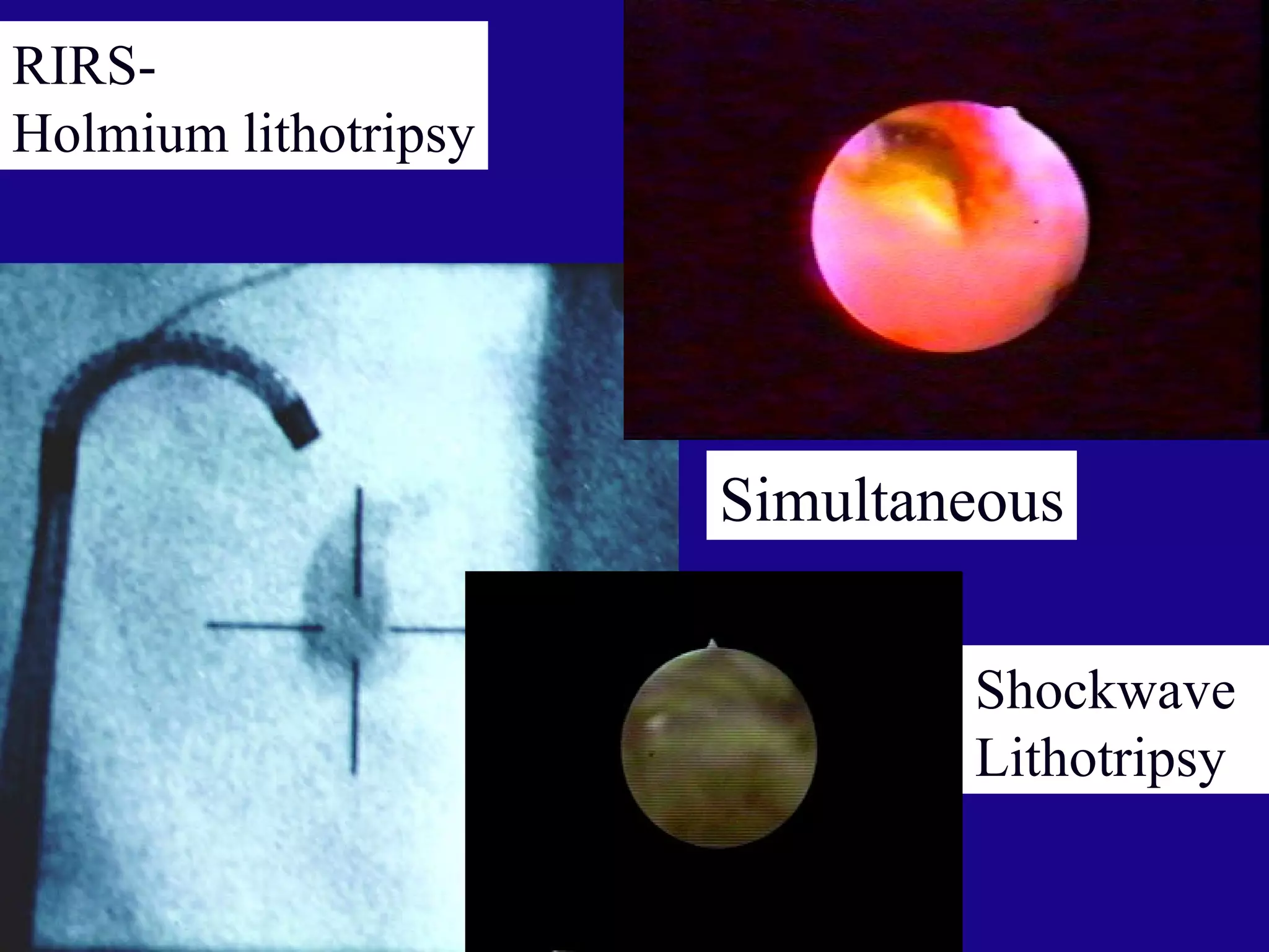 Retrograde Intrarenal Ureteroscopic Surgery (RIRS) | PPT