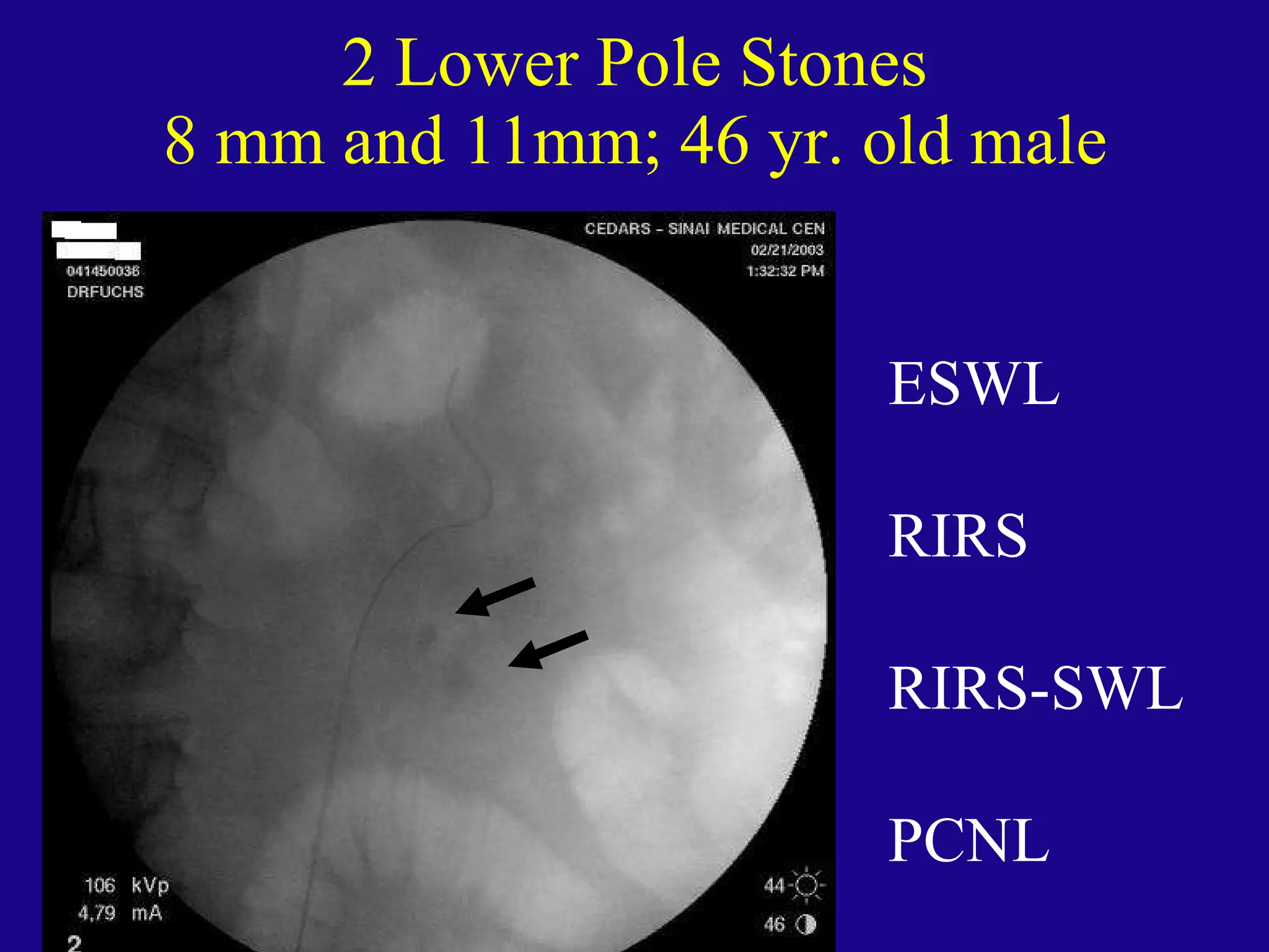 Retrograde Intrarenal Ureteroscopic Surgery (RIRS) | PPT