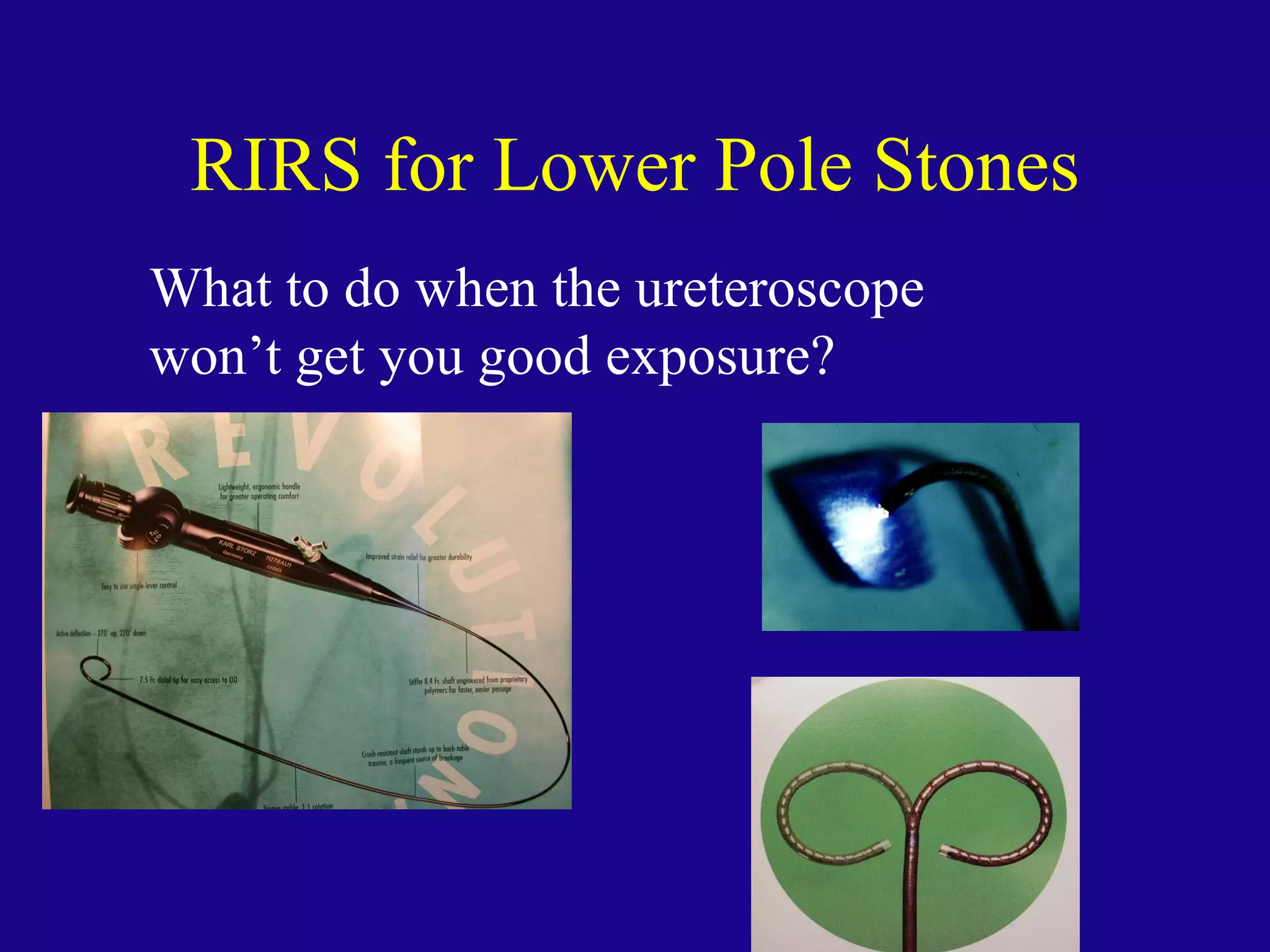 Retrograde Intrarenal Ureteroscopic Surgery (RIRS) | PPT