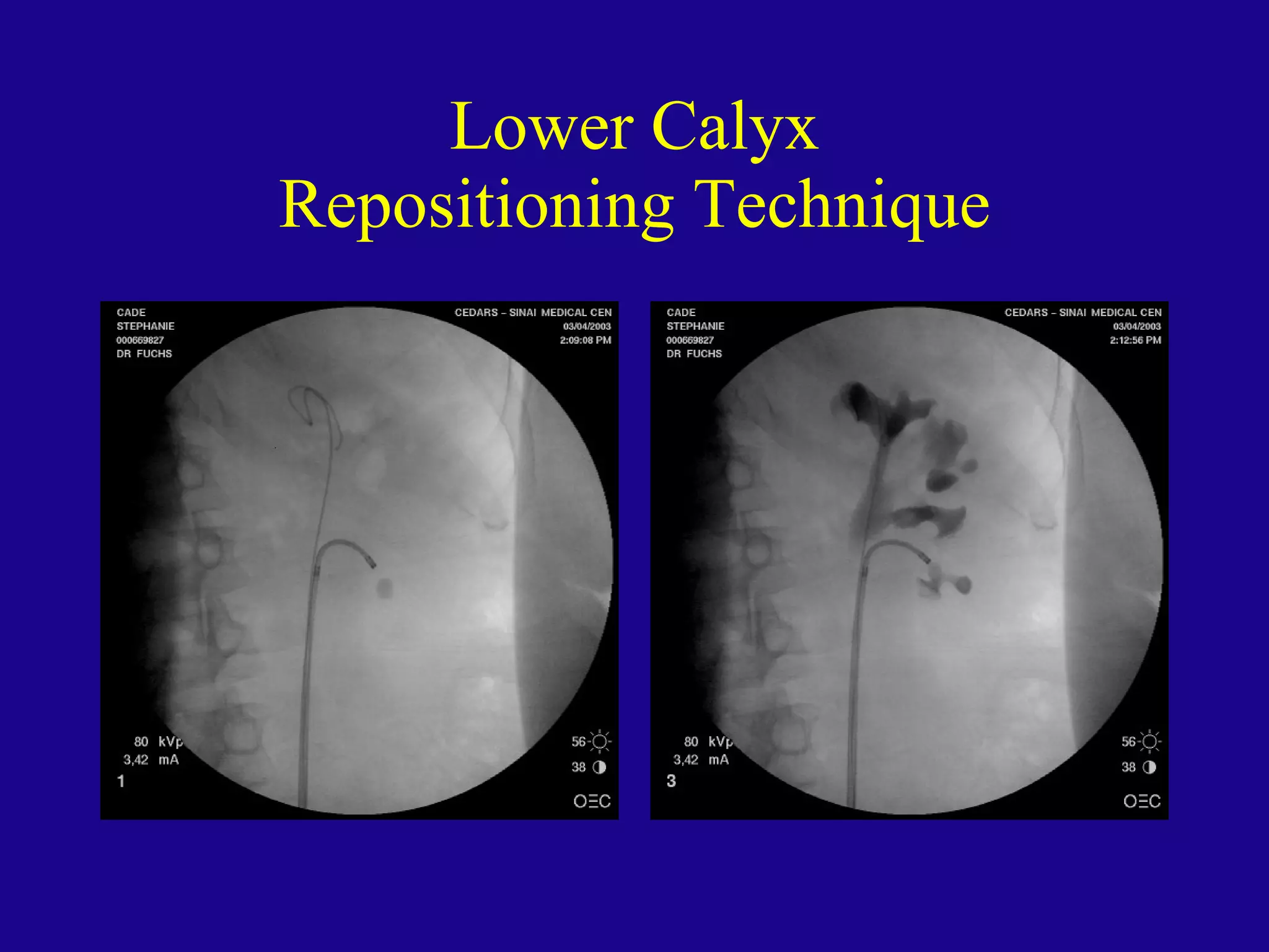 Retrograde Intrarenal Ureteroscopic Surgery (RIRS) | PPT