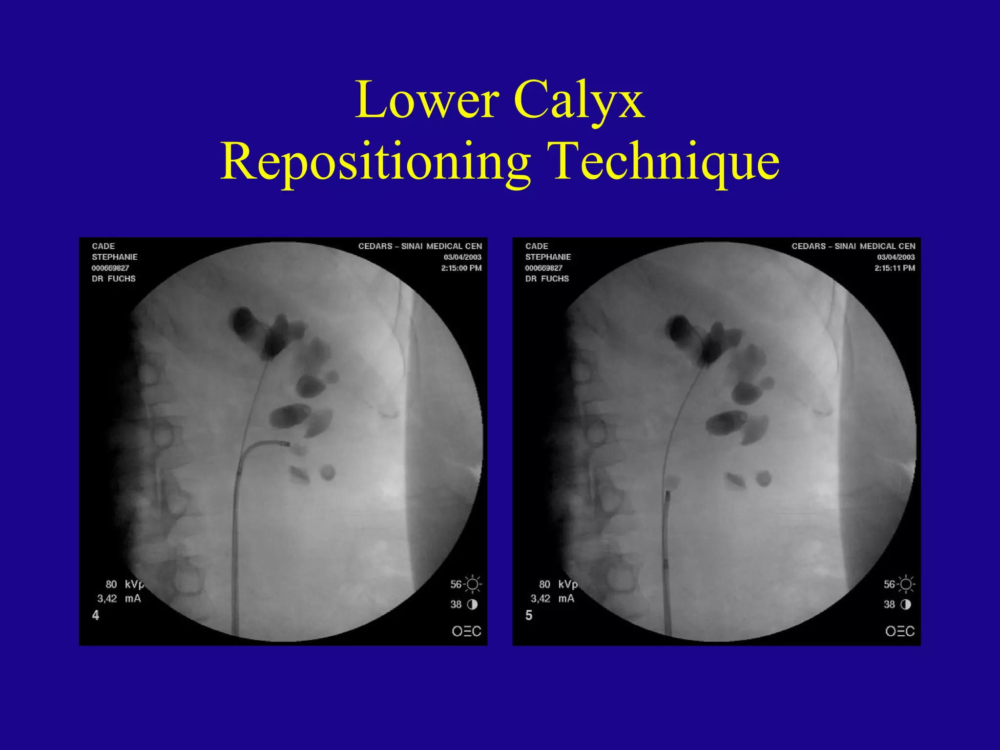 Retrograde Intrarenal Ureteroscopic Surgery (RIRS) | PPT
