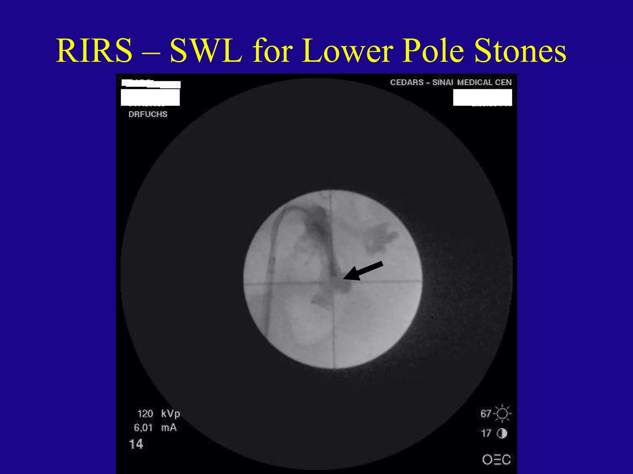 Retrograde Intrarenal Ureteroscopic Surgery (RIRS) | PPT