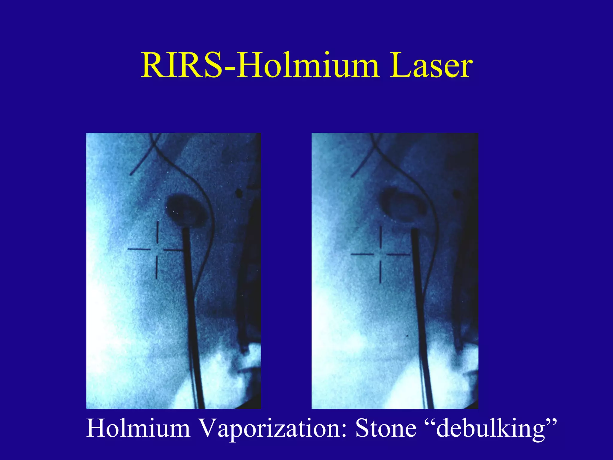 Retrograde Intrarenal Ureteroscopic Surgery (RIRS) | PPT