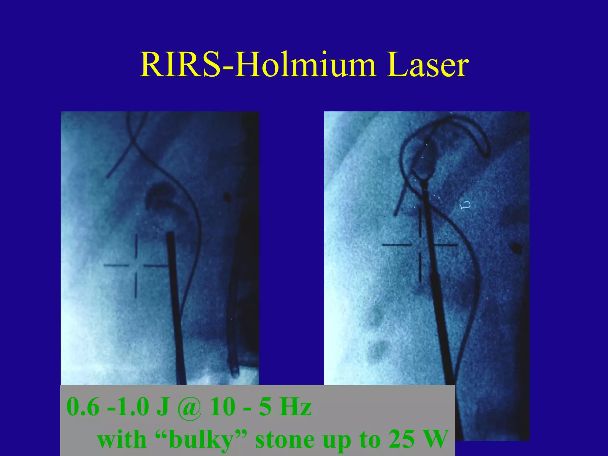 Retrograde Intrarenal Ureteroscopic Surgery (RIRS) | PPT