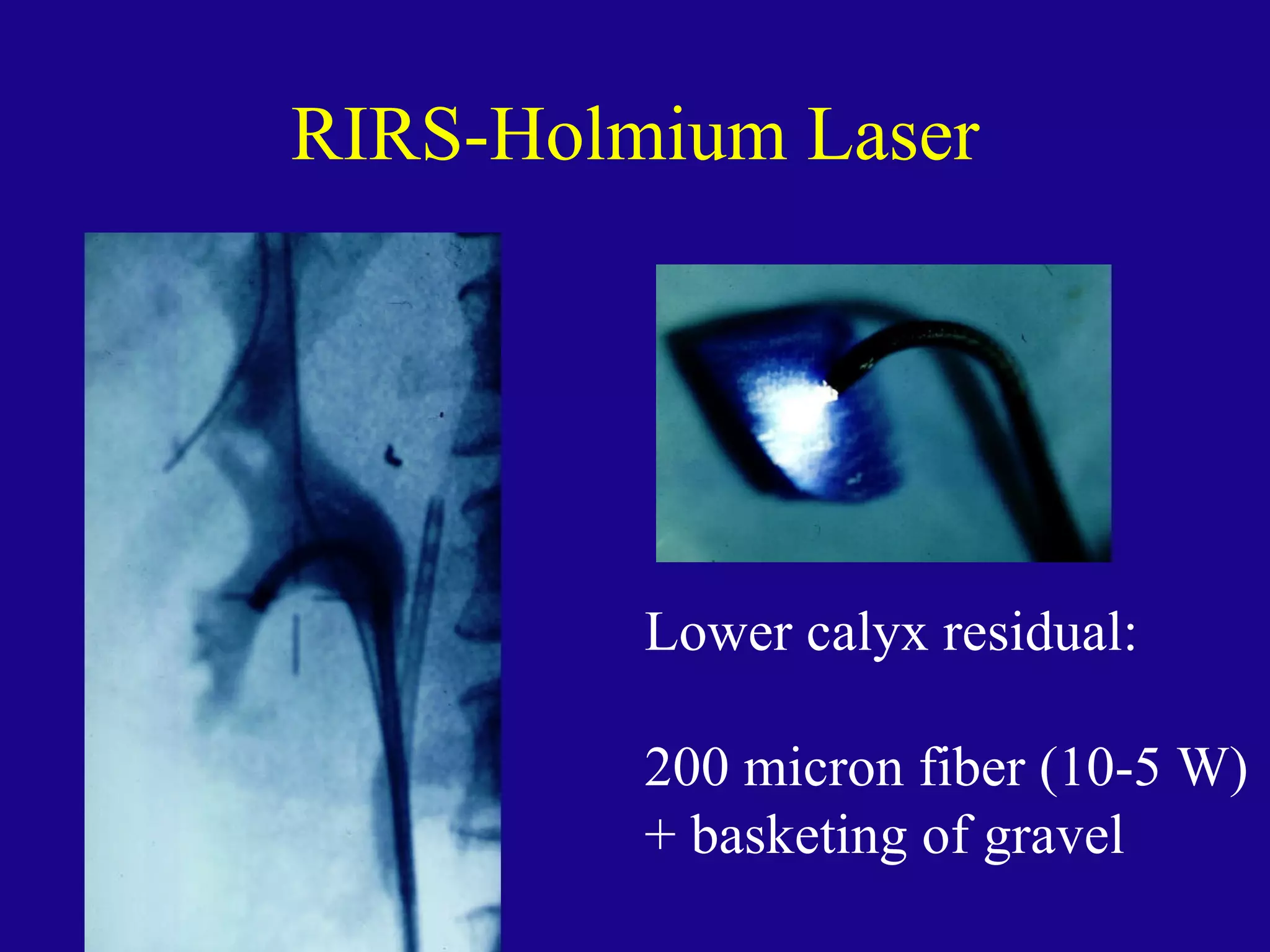 Retrograde Intrarenal Ureteroscopic Surgery (RIRS) | PPT