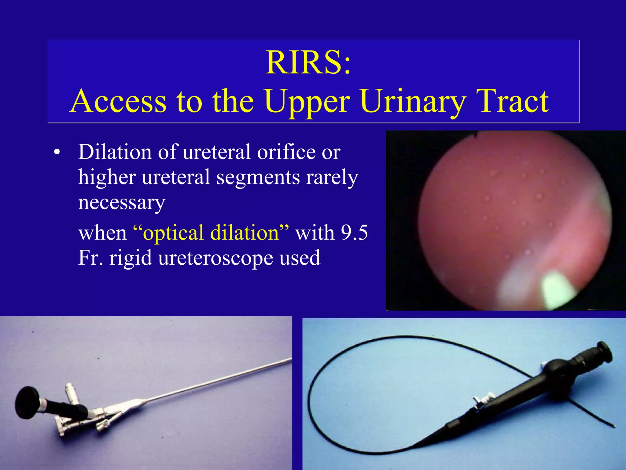 Retrograde Intrarenal Ureteroscopic Surgery (RIRS) | PPT