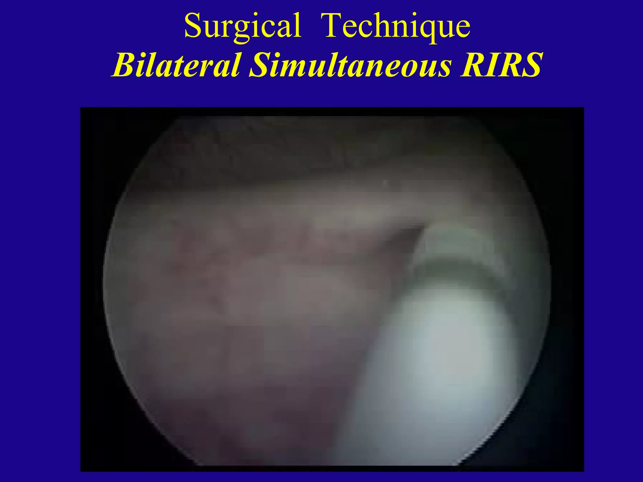 Retrograde Intrarenal Ureteroscopic Surgery (RIRS) | PPT