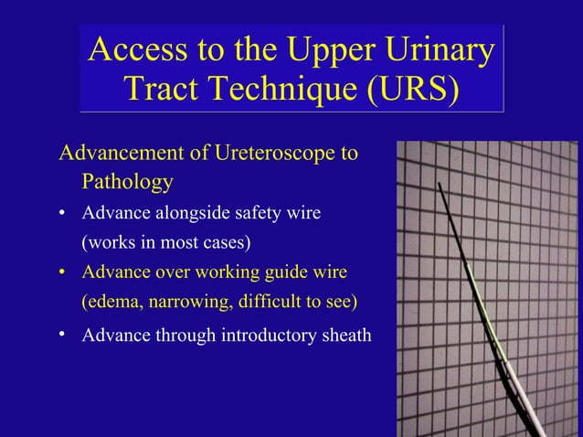 Retrograde Intrarenal Ureteroscopic Surgery (RIRS) | PPT