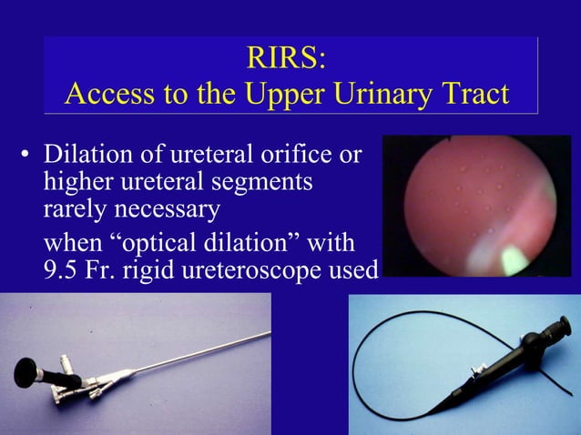 Retrograde Intrarenal Ureteroscopic Surgery (RIRS) | PPT