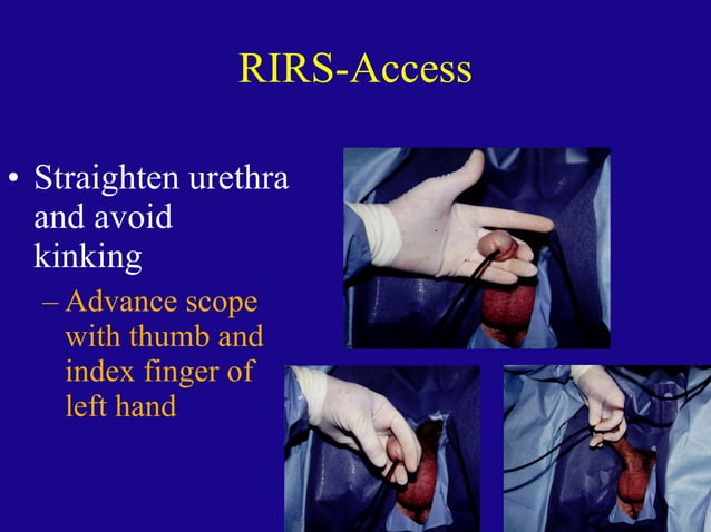 Retrograde Intrarenal Ureteroscopic Surgery (RIRS) | PPT