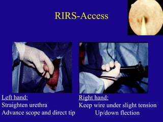 Retrograde Intrarenal Ureteroscopic Surgery (RIRS) | PPT