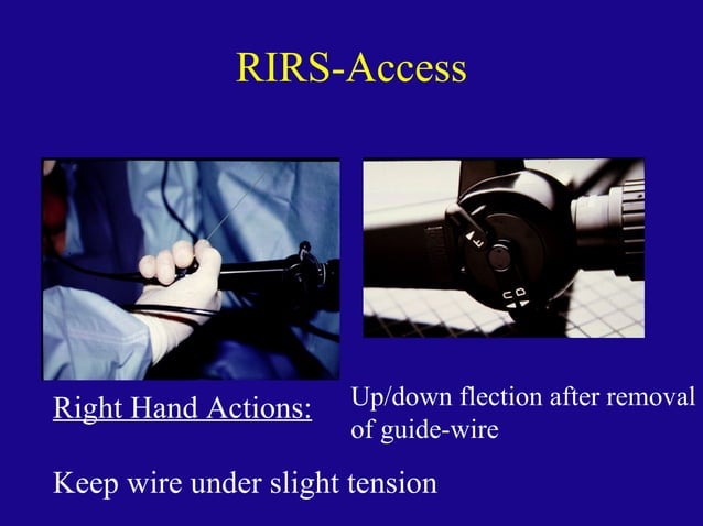 Retrograde Intrarenal Ureteroscopic Surgery (RIRS) | PPT