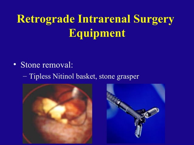 Retrograde Intrarenal Ureteroscopic Surgery (RIRS) | PPT