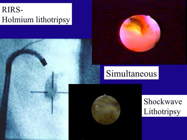 Retrograde Intrarenal Ureteroscopic Surgery (RIRS) | PPT