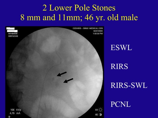Retrograde Intrarenal Ureteroscopic Surgery (RIRS) | PPT