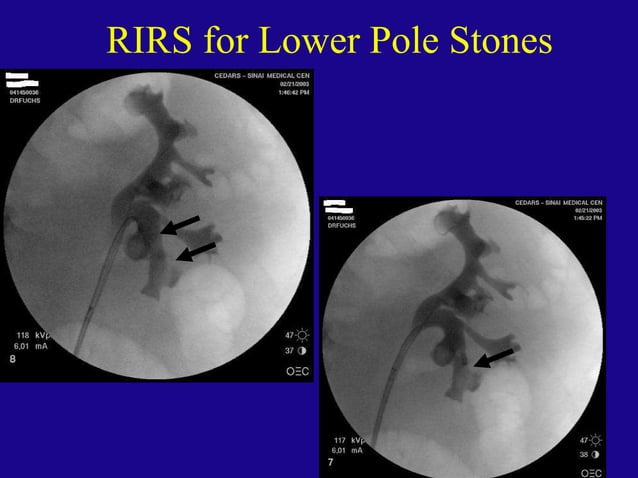 Retrograde Intrarenal Ureteroscopic Surgery (RIRS) | PPT