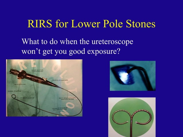 Retrograde Intrarenal Ureteroscopic Surgery (RIRS) | PPT