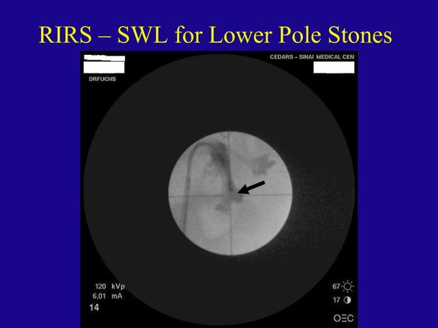 Retrograde Intrarenal Ureteroscopic Surgery (RIRS) | PPT