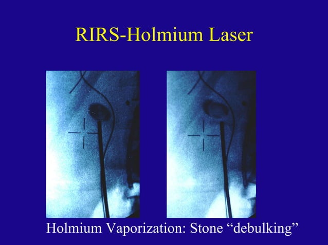 Retrograde Intrarenal Ureteroscopic Surgery (RIRS) | PPT