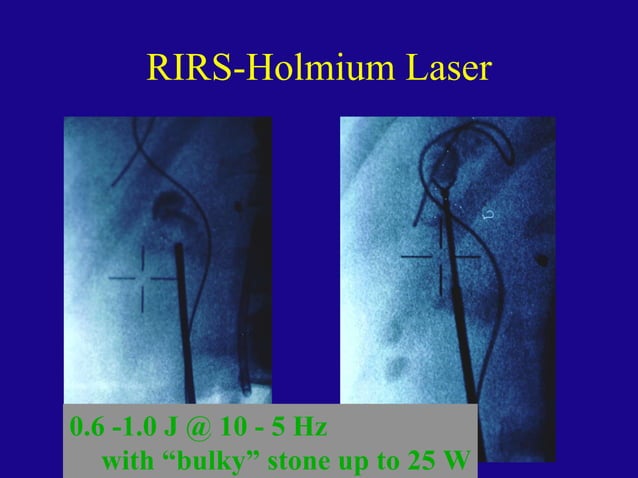 Retrograde Intrarenal Ureteroscopic Surgery (RIRS) | PPT